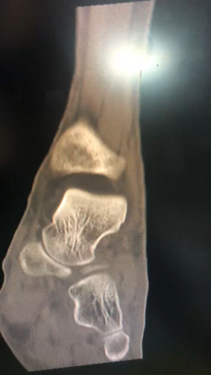 Sanders IV型跟骨骨折，可否全闭合复位？附复位详细步骤和连续CT